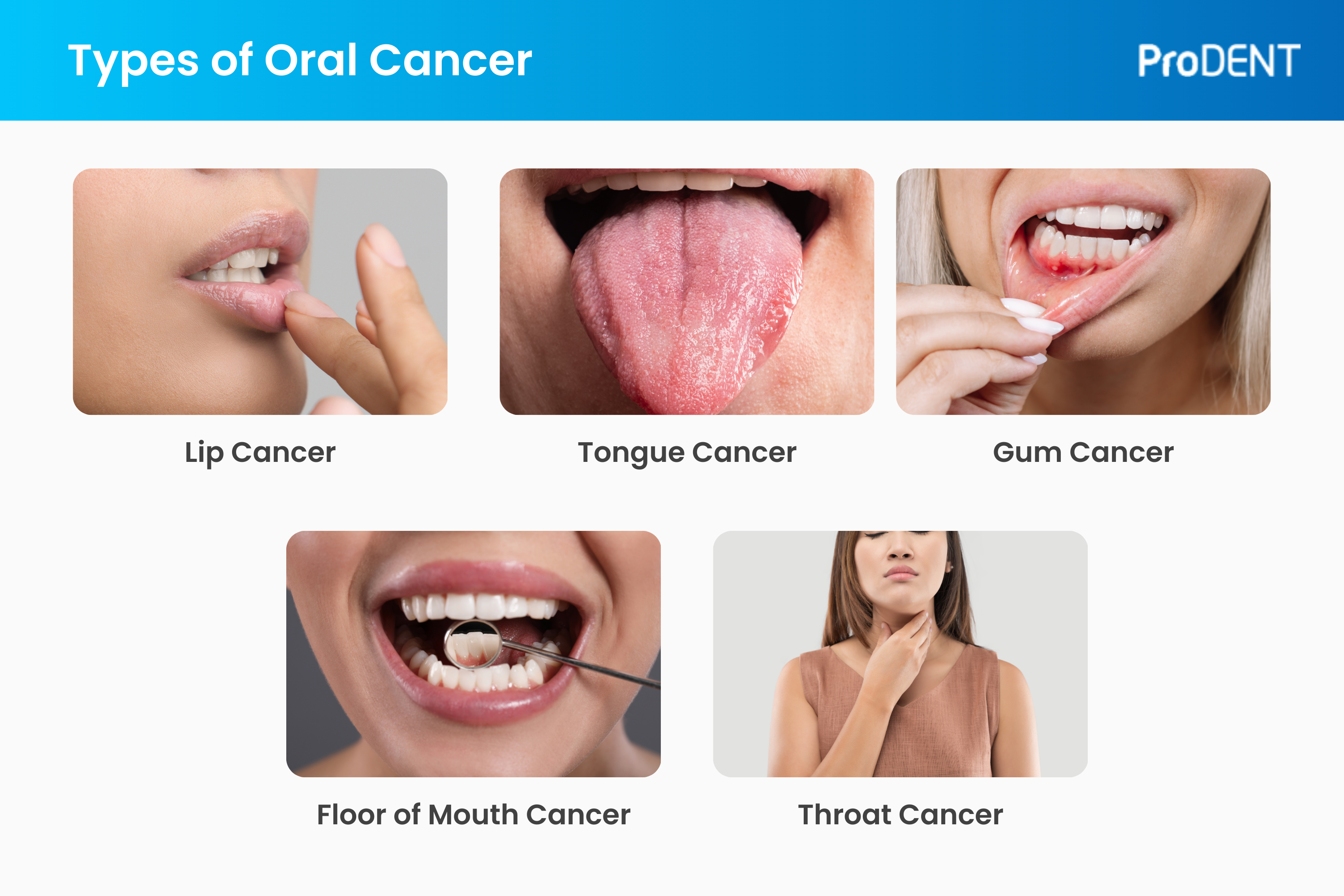 mouth cancer symptoms